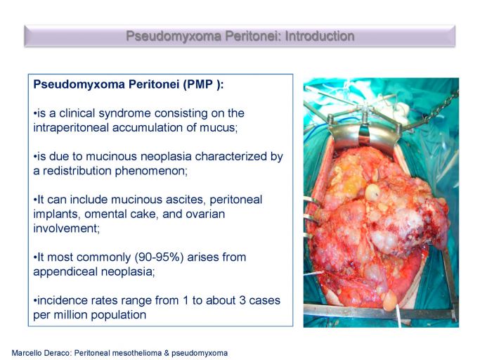 Diapositive su Neoplasie dell’Appendice Ciecale e Pseudomixoma ...